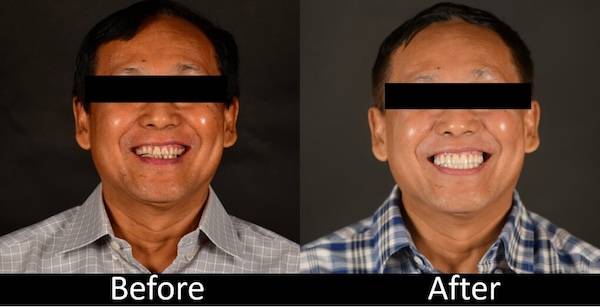 How to scan Implant models using scan body by our Shining 3D dental Lab ...