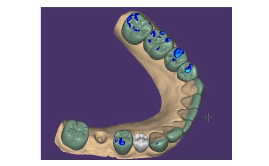 How to scan Implant models using scan body by our Shining 3D dental Lab ...