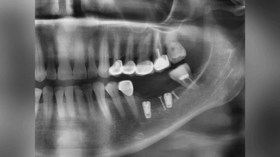How to scan Implant models using scan body by our Shining 3D dental Lab ...