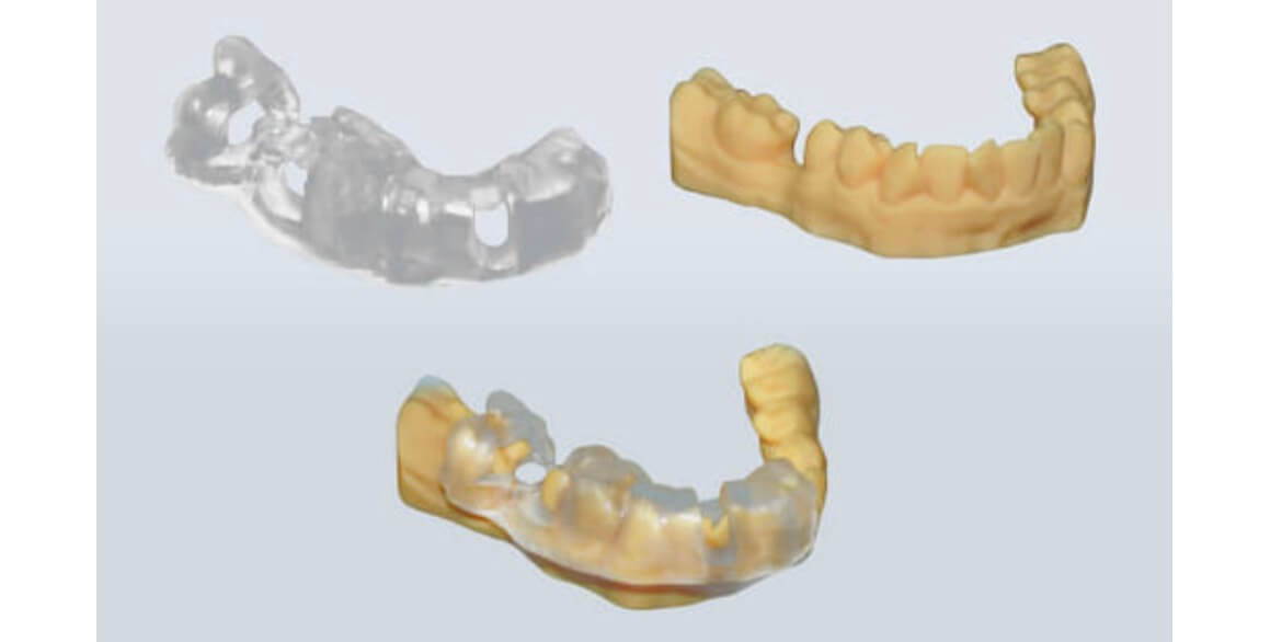 NARROW DIAMETER IMPLANT IN POSTERIOR MANDIBLE – ADAE Dental Online Store