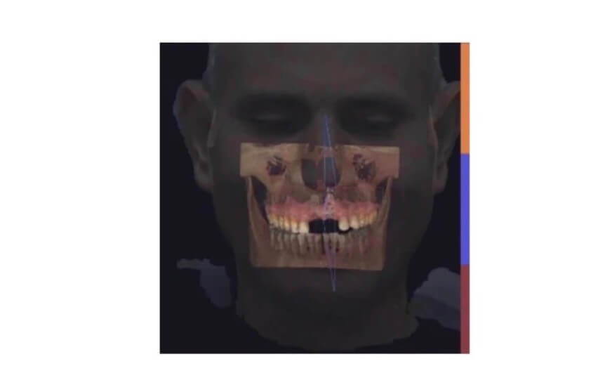 How to scan Implant models using scan body by our Shining 3D dental Lab ...