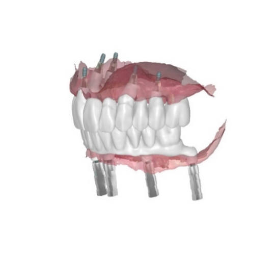 How to scan Implant models using scan body by our Shining 3D dental Lab ...