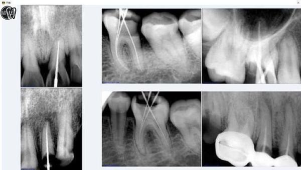 ATECO sensor X-ray sensor (UK-made)-New upgraded version – ADAE Dental ...